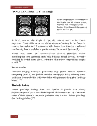 Frontotemporal dementia 2018 | PDF