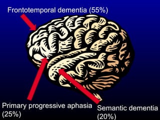 Frontotemporal Dementia: An Overview | PPT