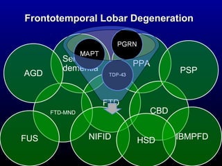 Frontotemporal Dementia: An Overview | PPT