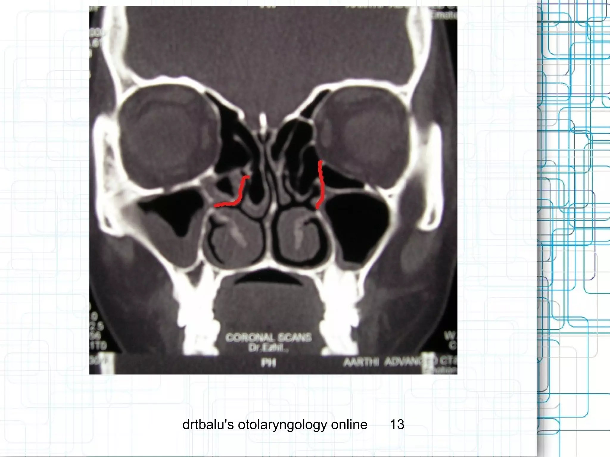 Radiological anatomy of frontal sinus | PPT
