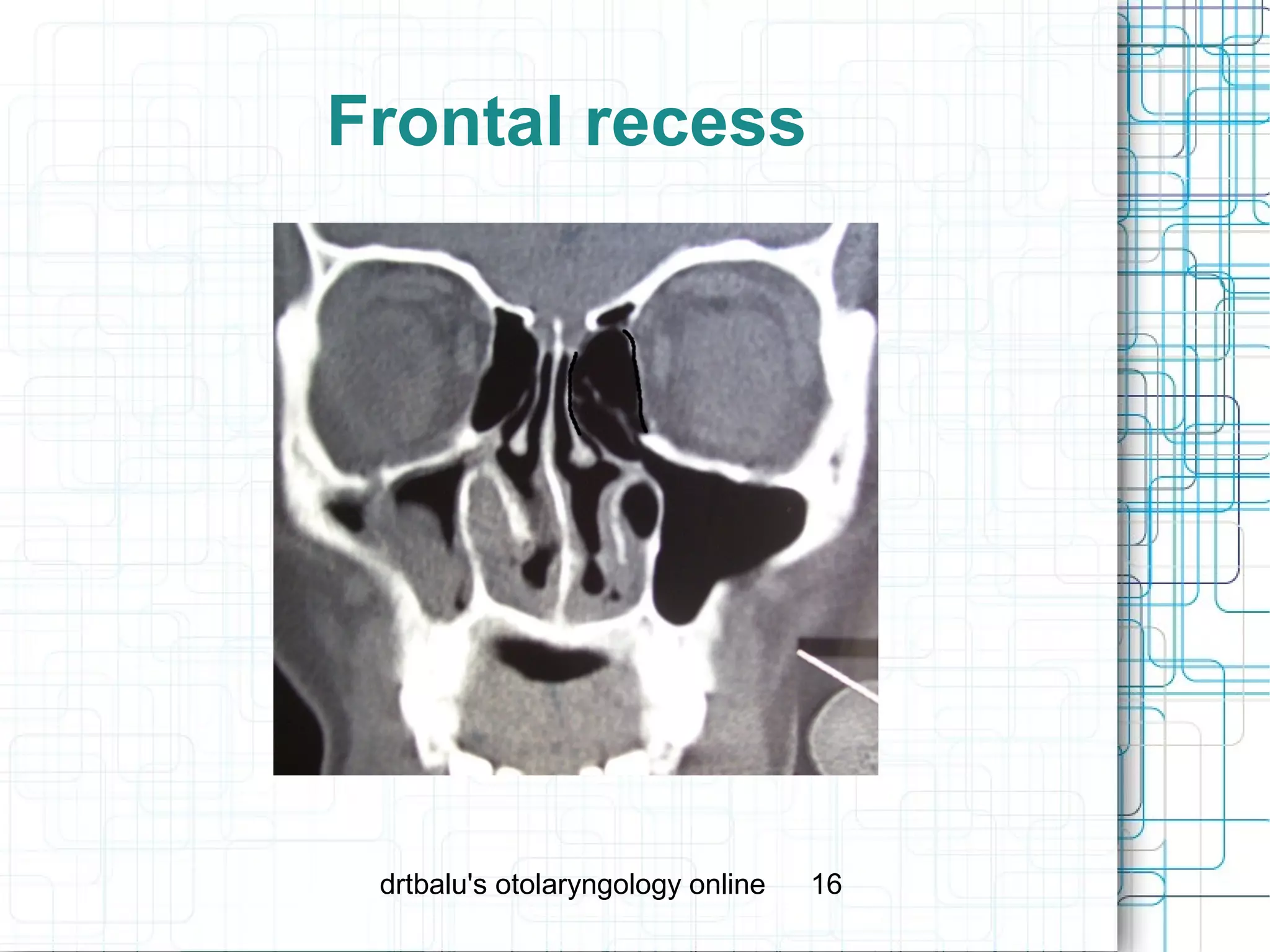 Radiological anatomy of frontal sinus | PPT