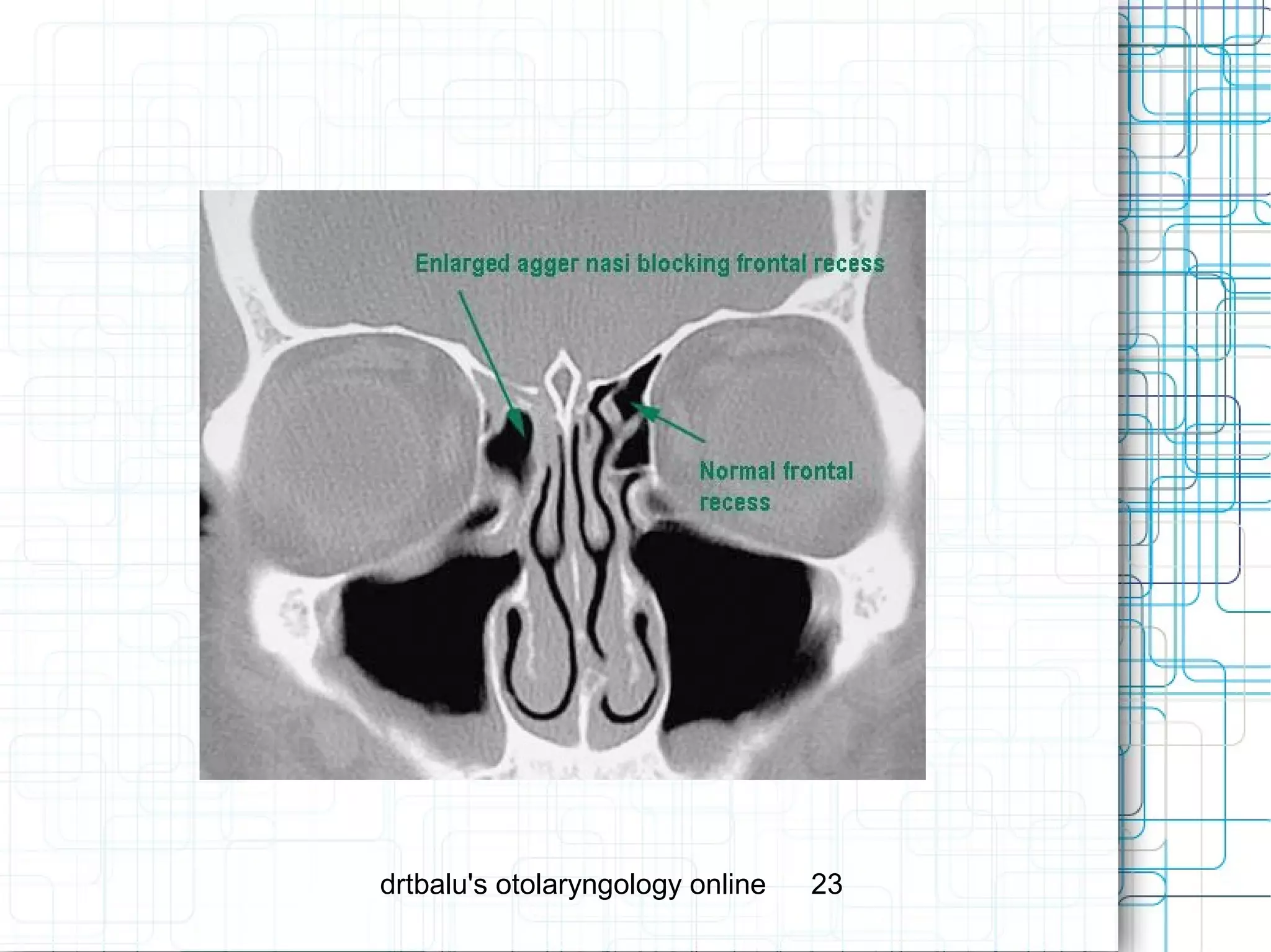 Radiological anatomy of frontal sinus | PPT