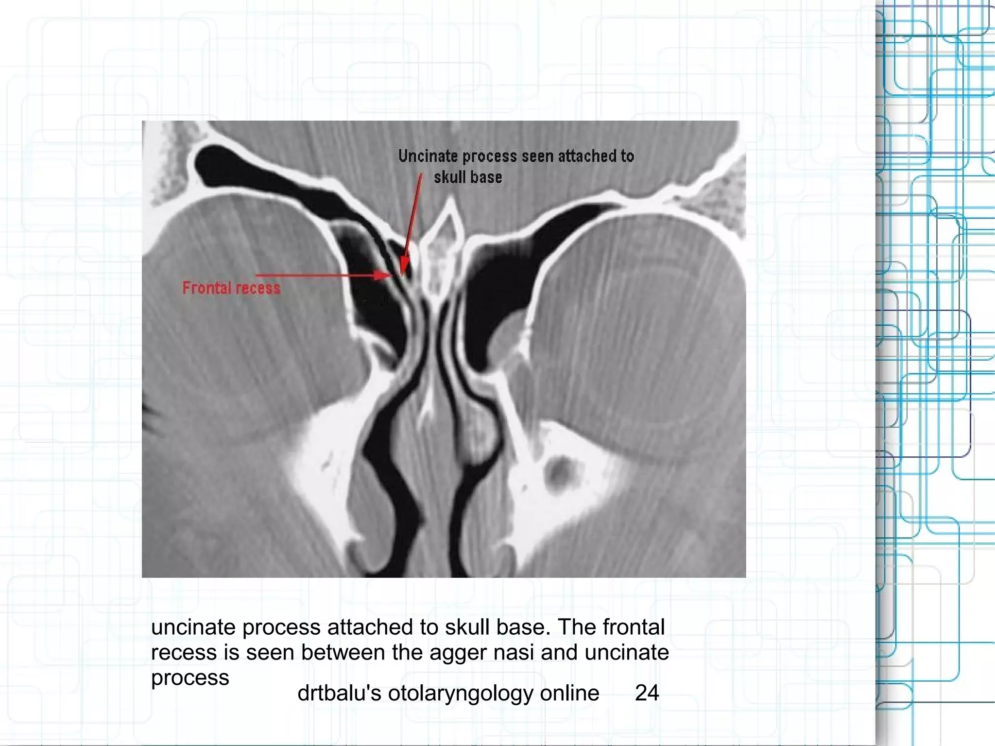 Radiological anatomy of frontal sinus | PPT