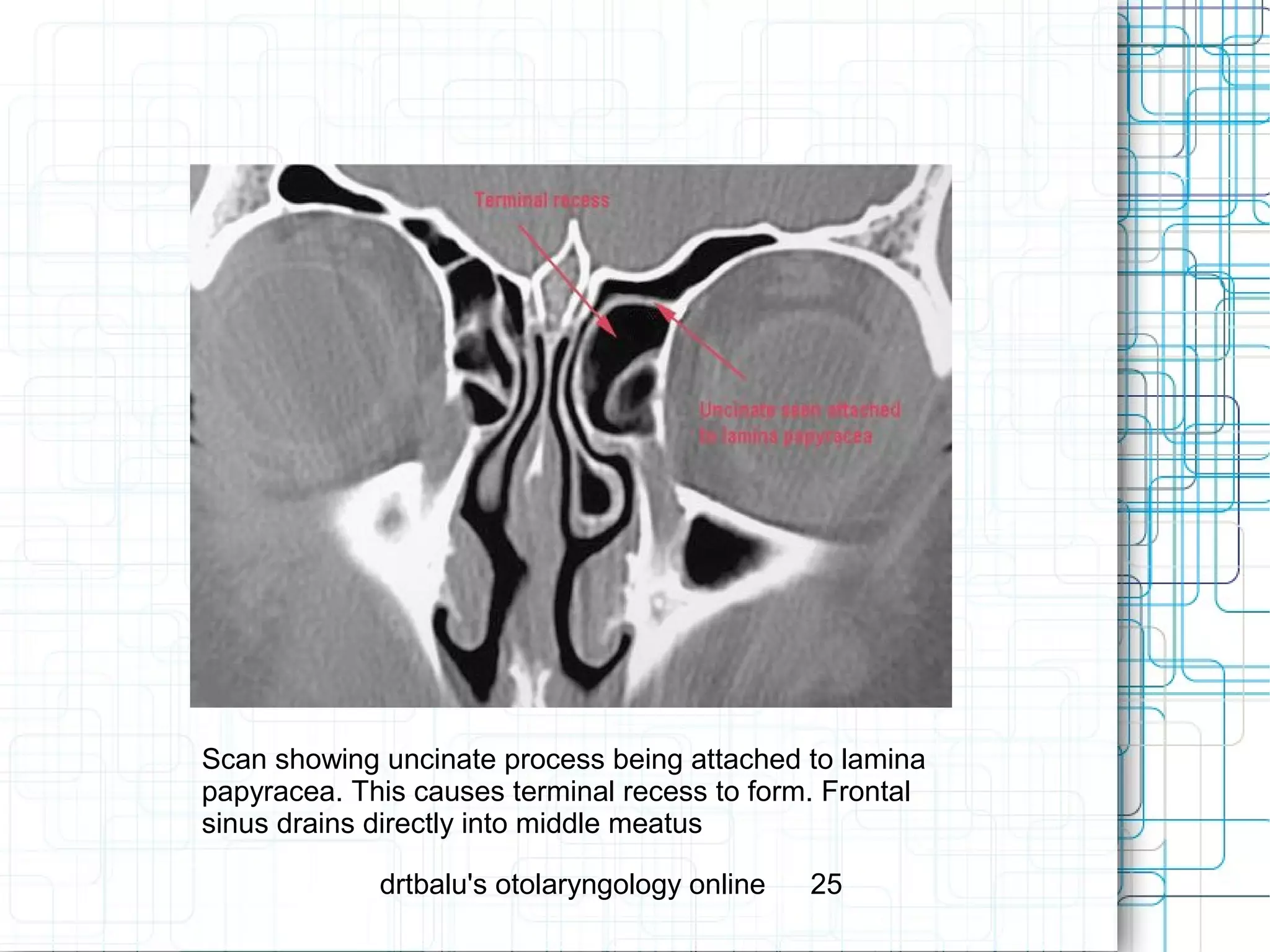 Radiological anatomy of frontal sinus | PPT