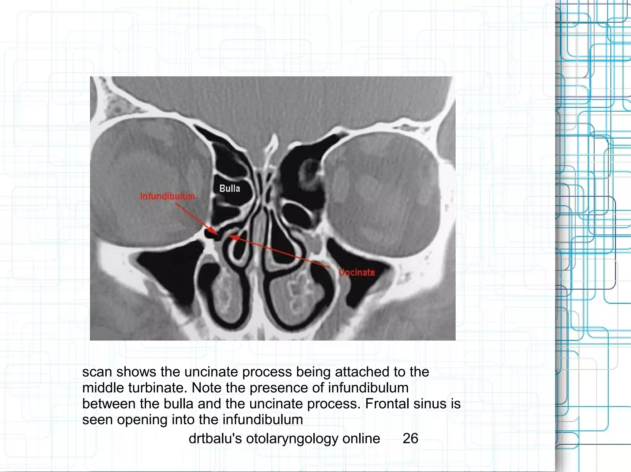 Radiological anatomy of frontal sinus | PPT