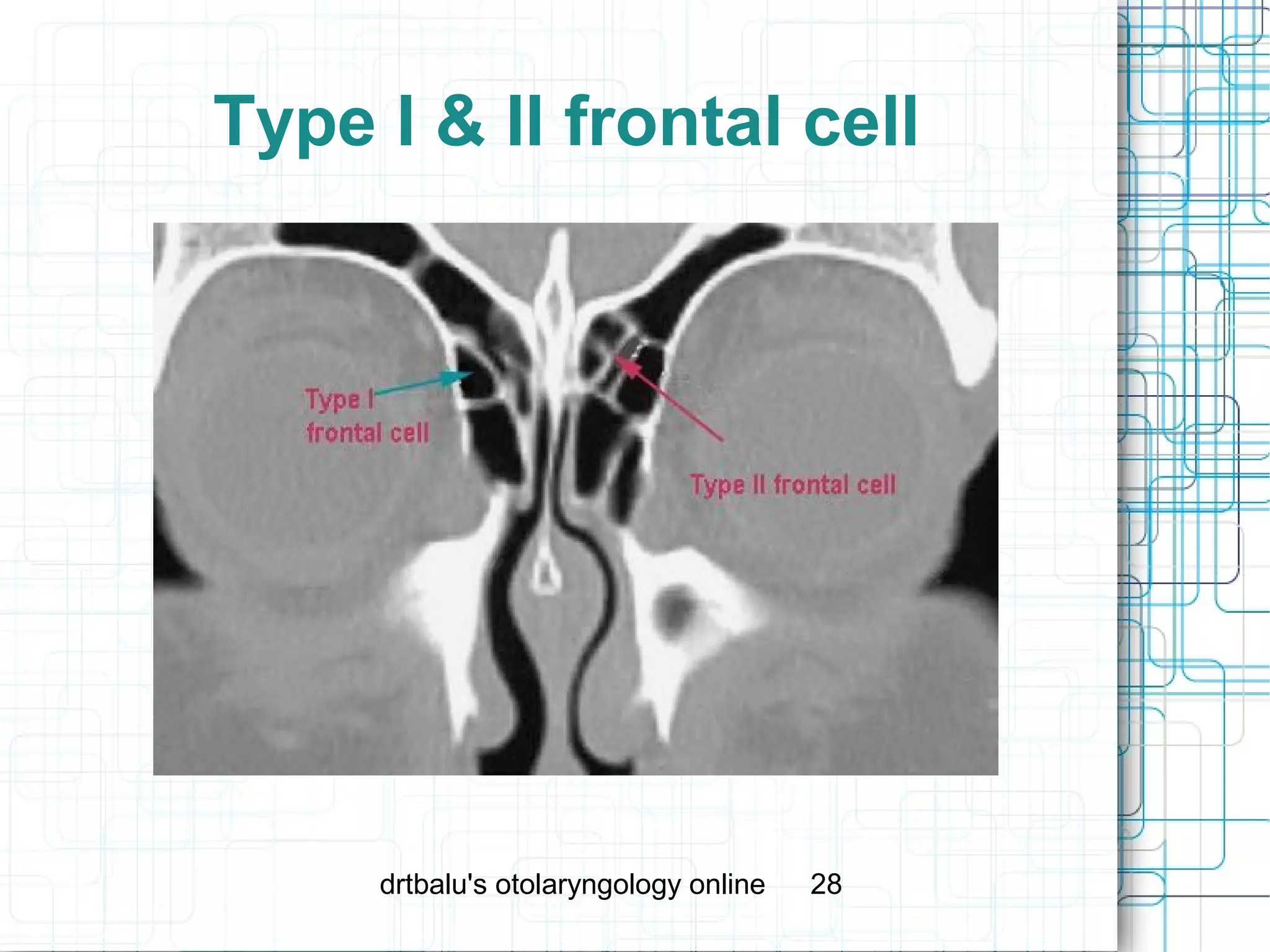Radiological anatomy of frontal sinus | PPT