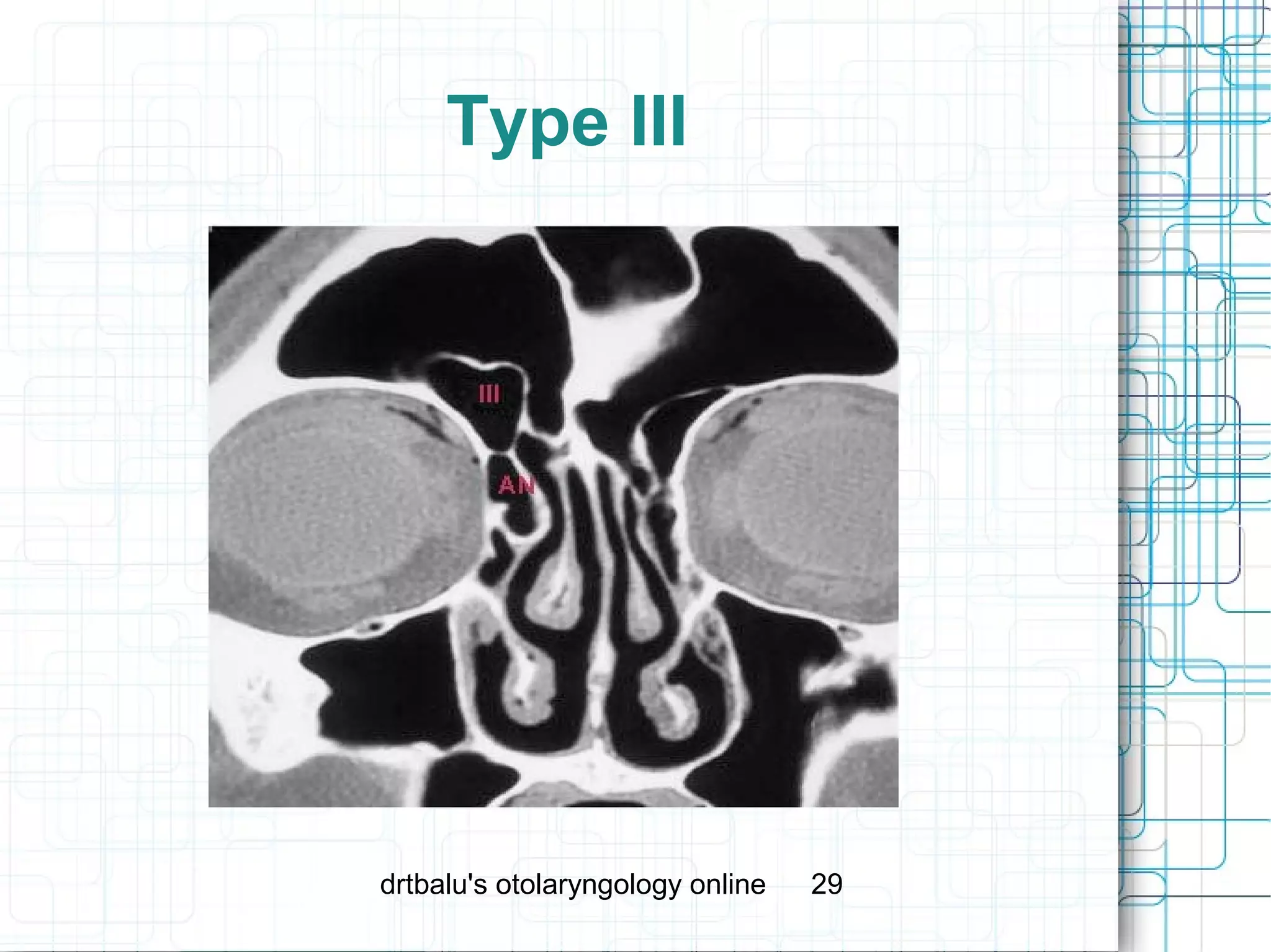 Radiological anatomy of frontal sinus | PPT