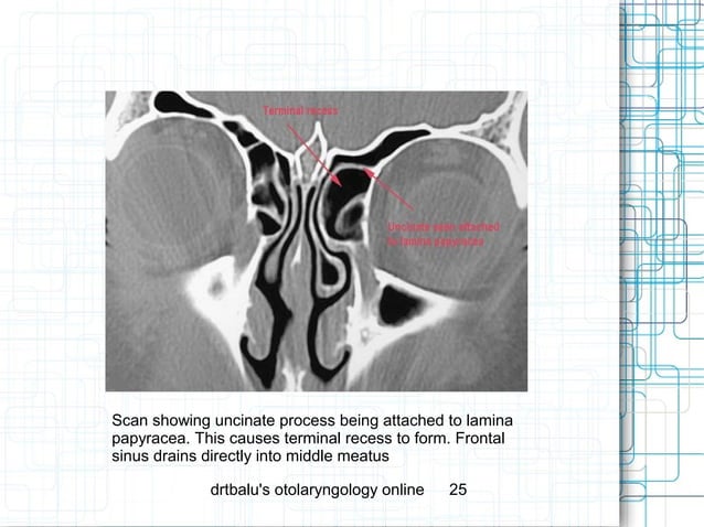 Radiological anatomy of frontal sinus | PPT