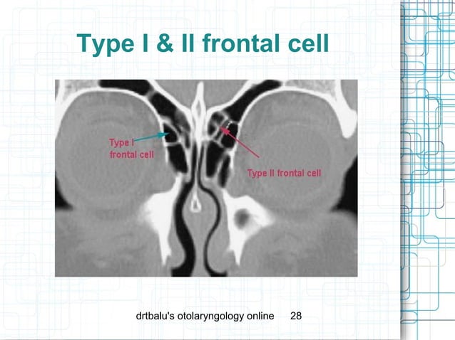 Radiological anatomy of frontal sinus | PPT