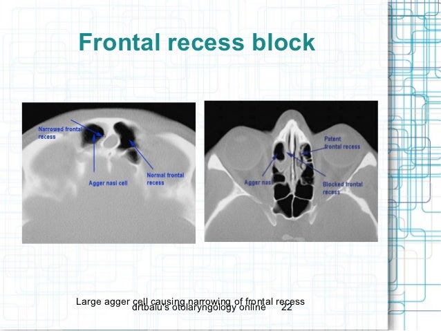 Radiological anatomy of frontal sinus