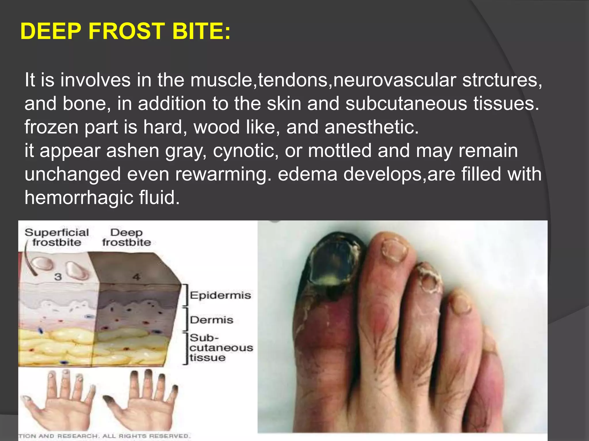 Frost bite | PPTX