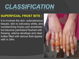 White Waxy Frostbite Toes