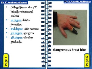 Frost bite | PPTX