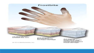 FROST BITE.pptx