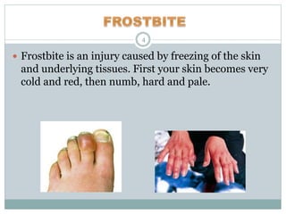 Frostbite by insha_ur_rahman[1] | PPTX | Death, Injury, or Military ...