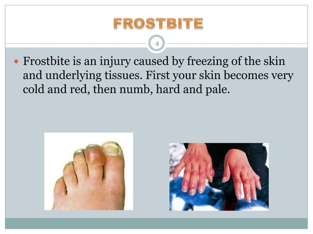 Frostbite by insha_ur_rahman[1] | PPTX | Death, Injury, or Military ...