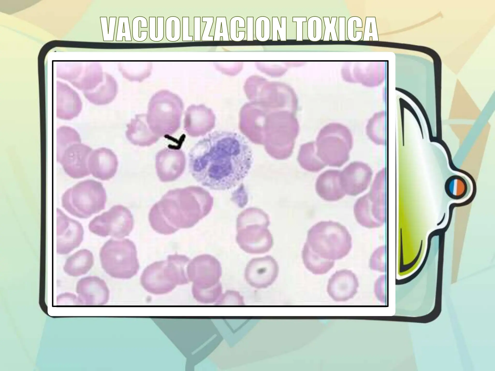 Interpretation of the peripheral smear and CBC | PPT