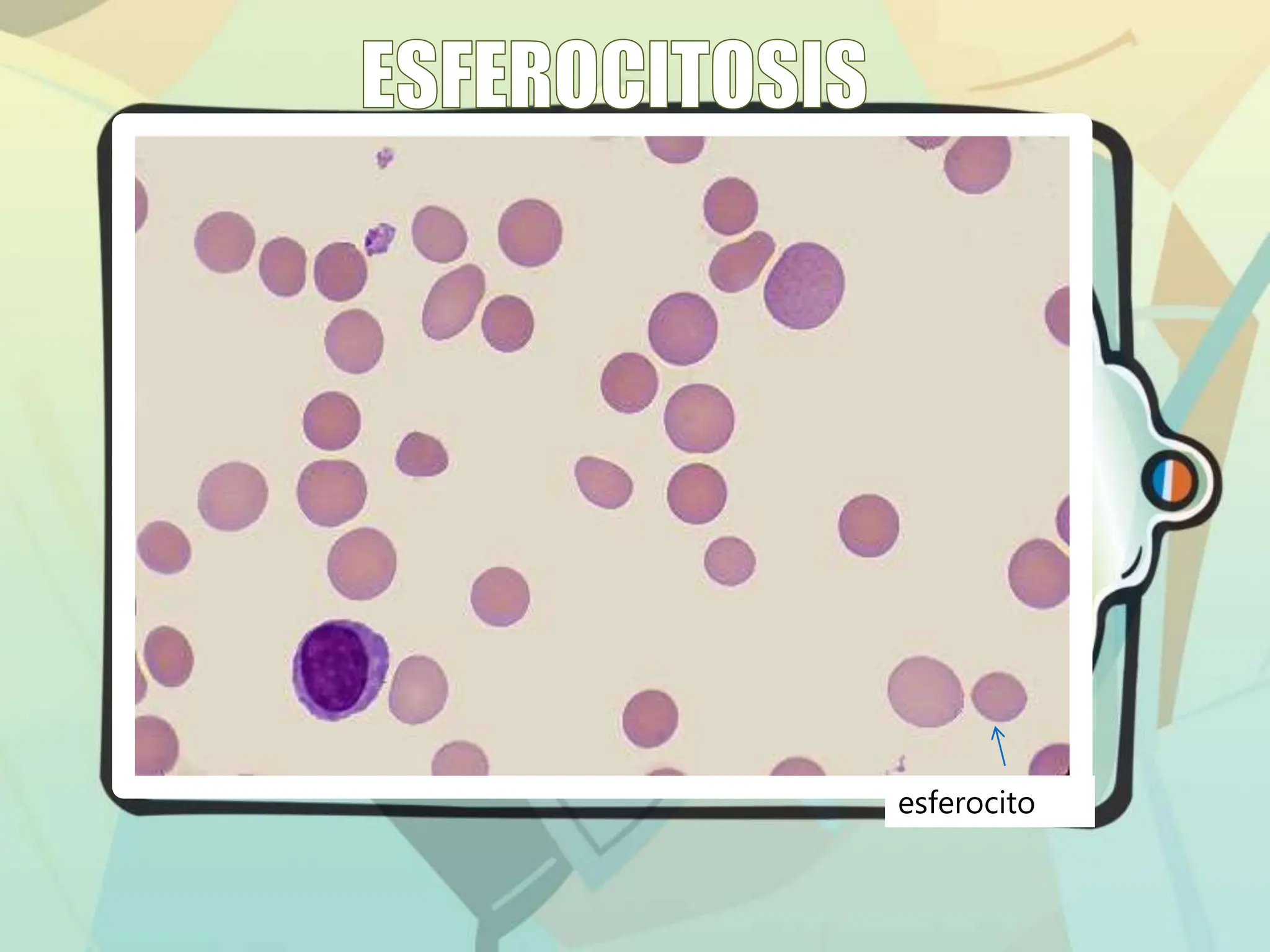 Interpretation of the peripheral smear and CBC | PPT