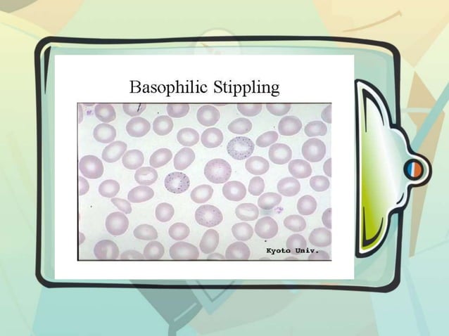 Interpretation of the peripheral smear and CBC | PPT