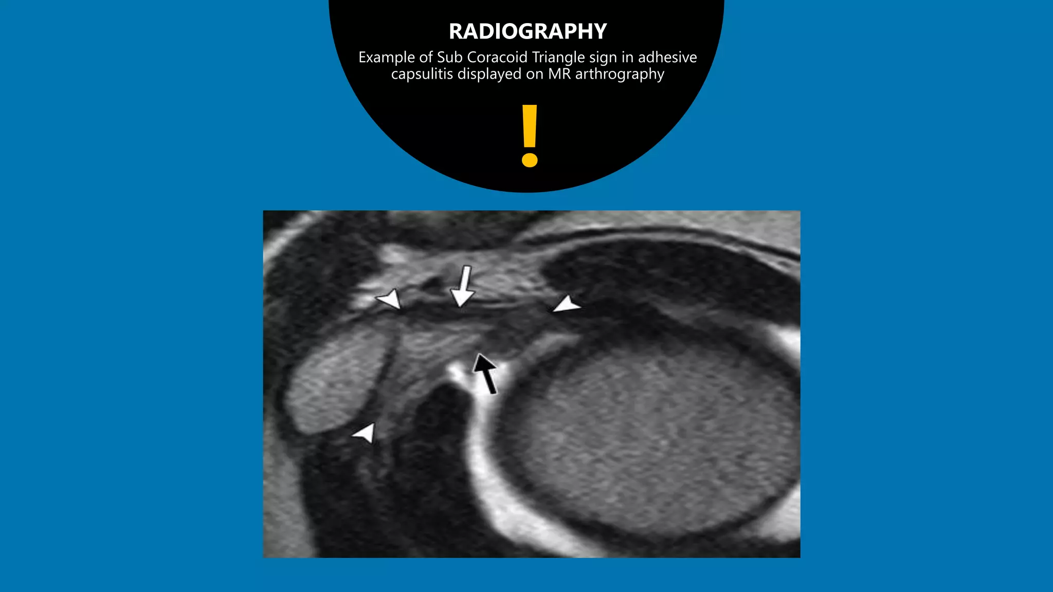 Frozen Shoulder ( Adhesive Capsulitis ) | PPTX
