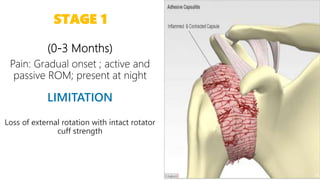 Frozen Shoulder ( Adhesive Capsulitis ) | PPTX