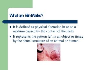 FRS 310 Bite mark.pptx