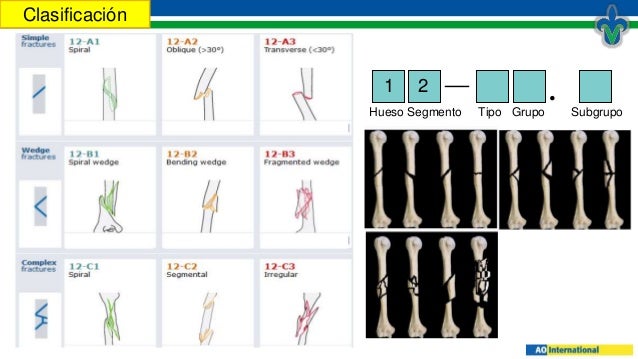 Fracturas de la diáfisis del húmero