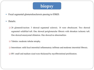 Recurrent FSGS after transplantation | PPTX