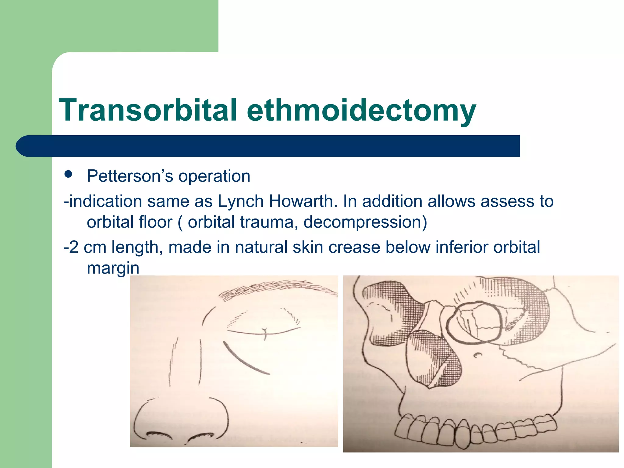 surgical management of sinusitis | PPT