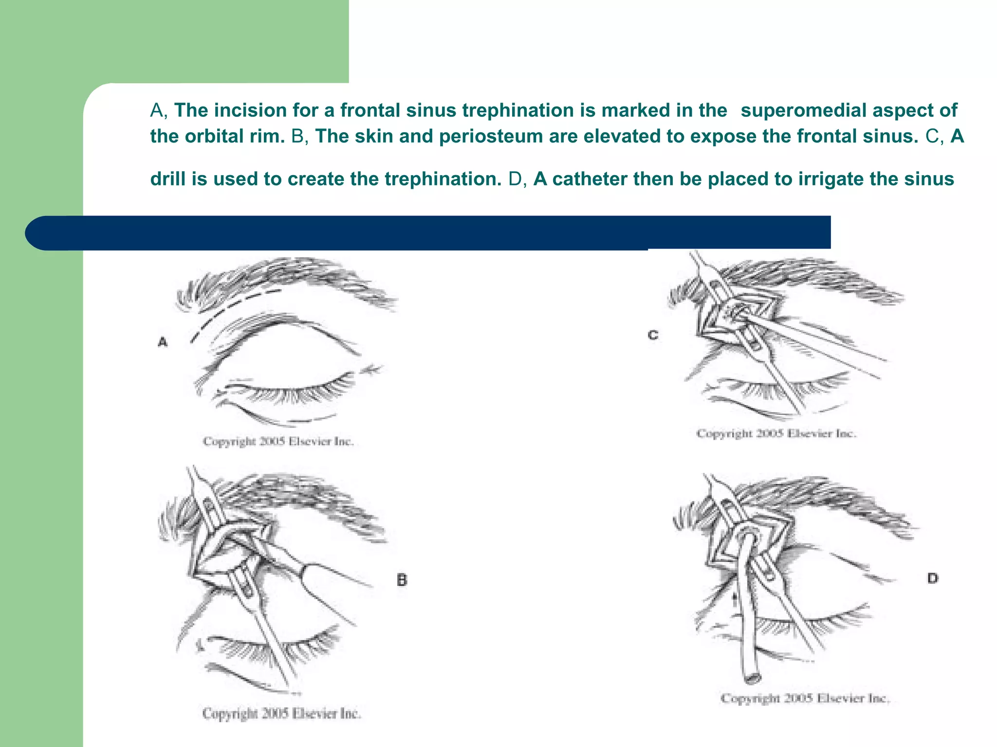 surgical management of sinusitis | PPT