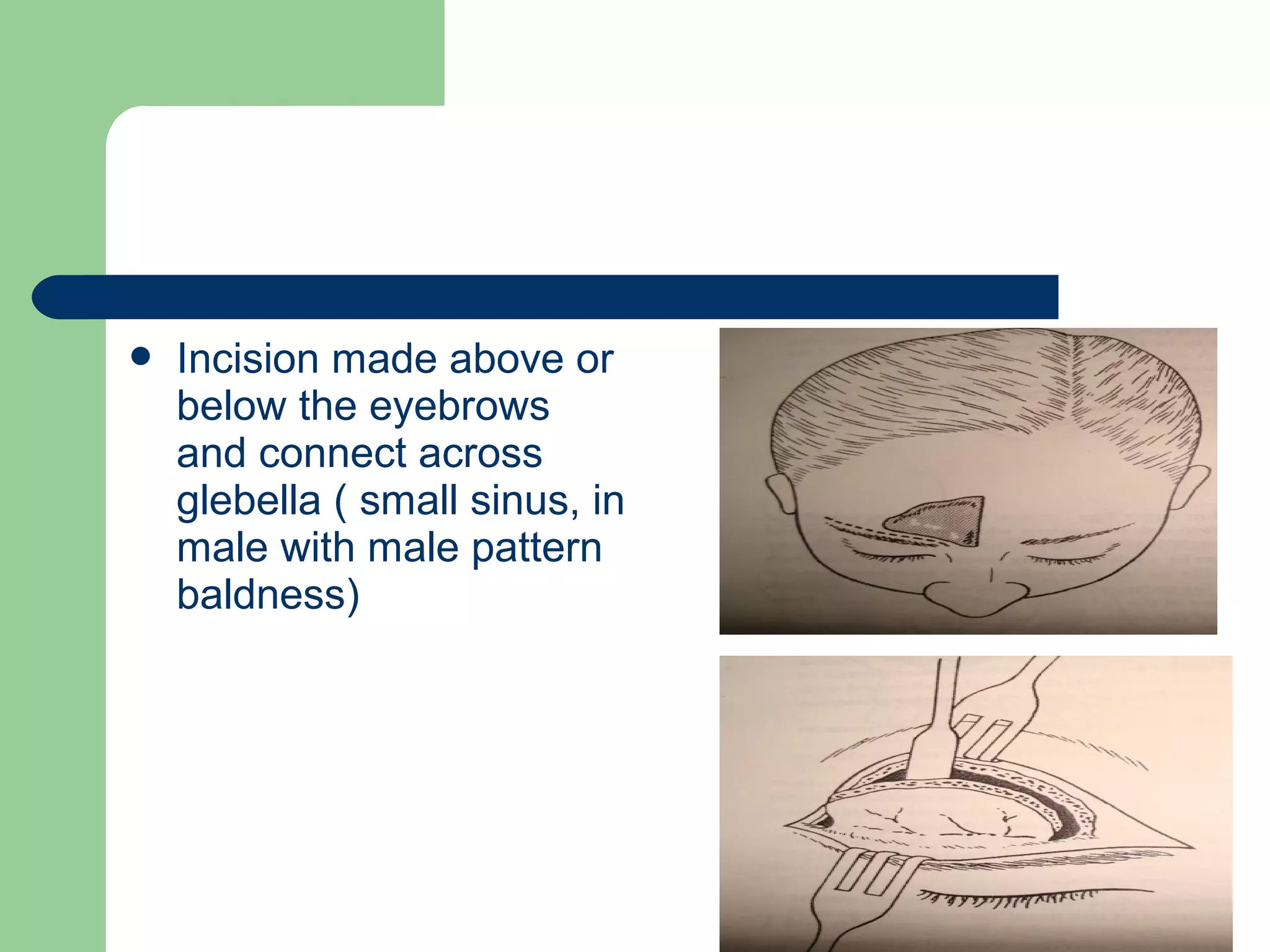 surgical management of sinusitis | PPT