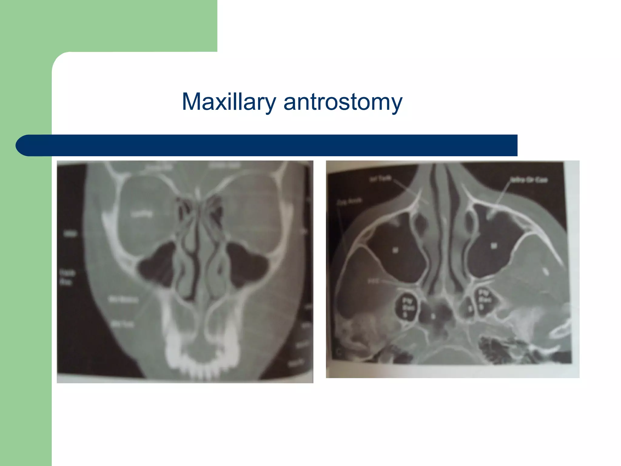surgical management of sinusitis | PPT