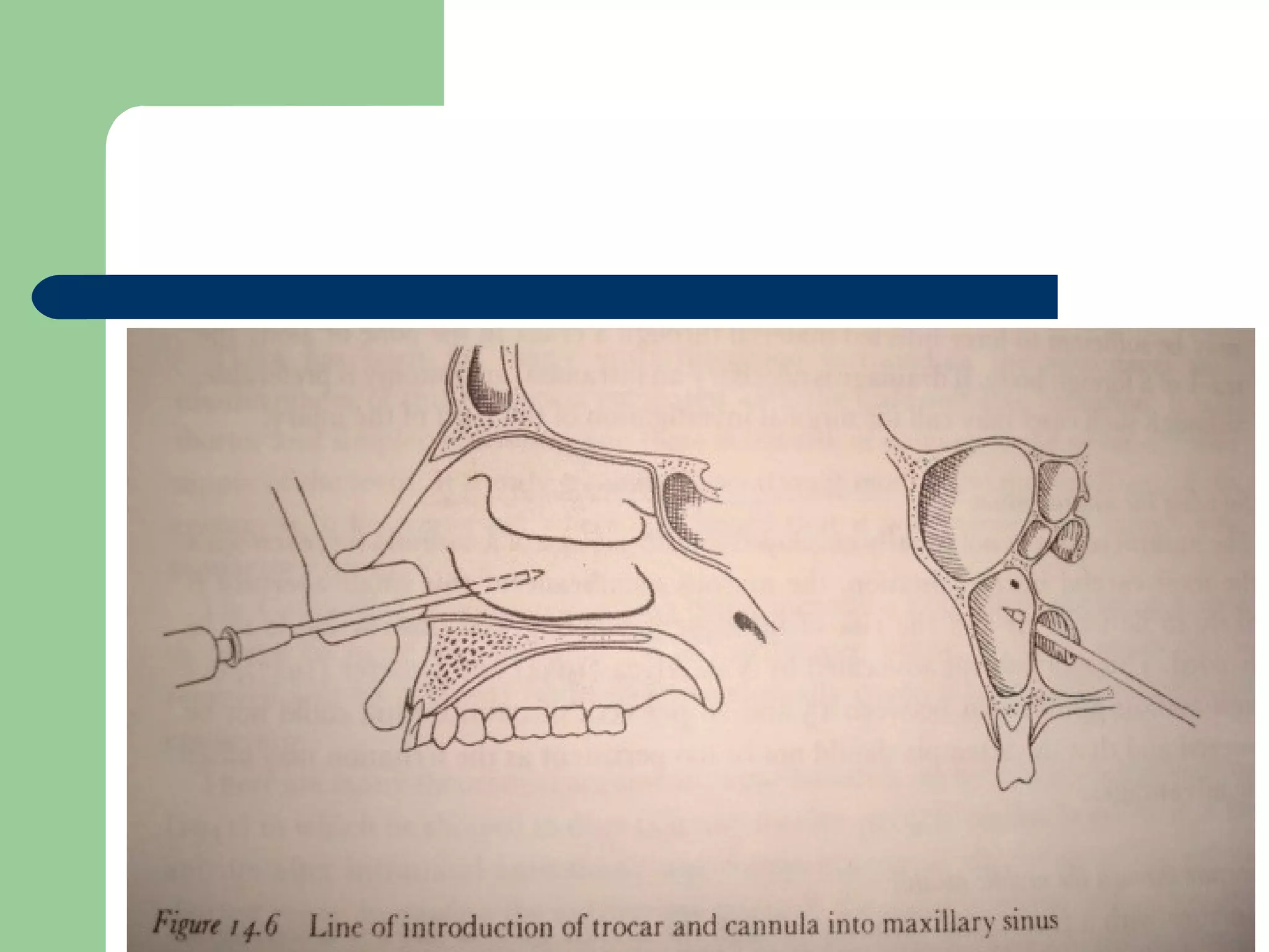 surgical management of sinusitis | PPT