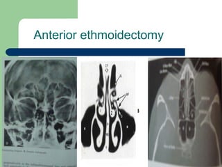 surgical management of sinusitis | PPT