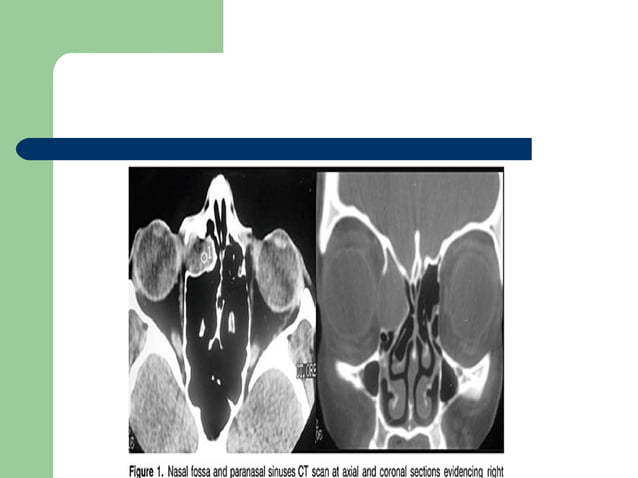 surgical management of sinusitis | PPT | Death, Injury, or Military ...