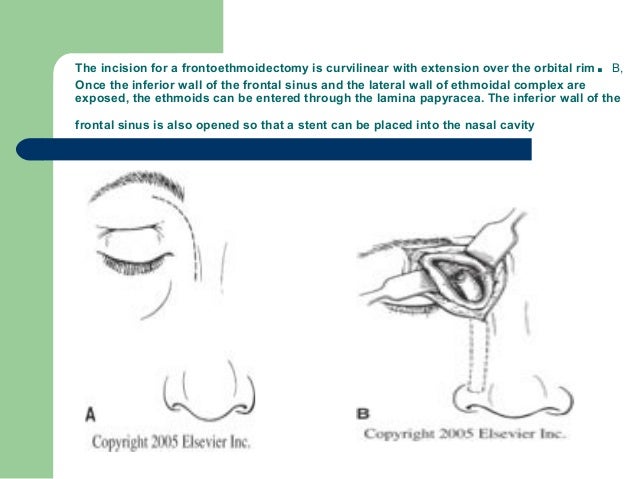 surgical management of sinusitis