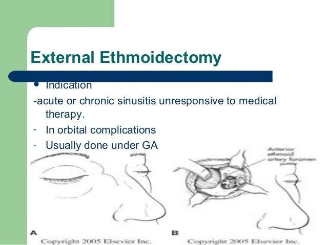 surgical management of sinusitis