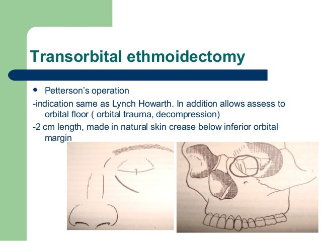 surgical management of sinusitis