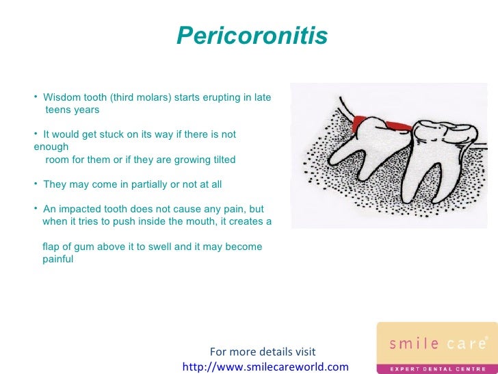 Pericoronitis