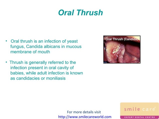 Oral Thrush | PPT | Dental Health | Diseases and Conditions