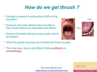Oral Thrush | PPT