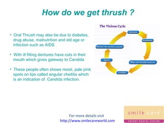Oral Thrush | PPT