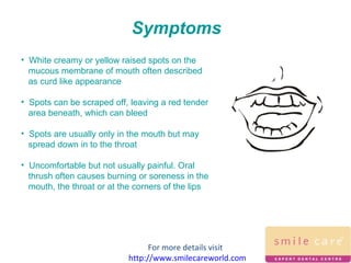Oral Thrush | PPT
