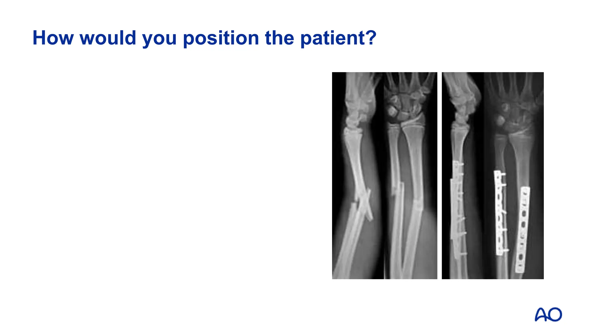 FSP_ORP_Discussion_English_Forearm_fracture_nLogo.ppt