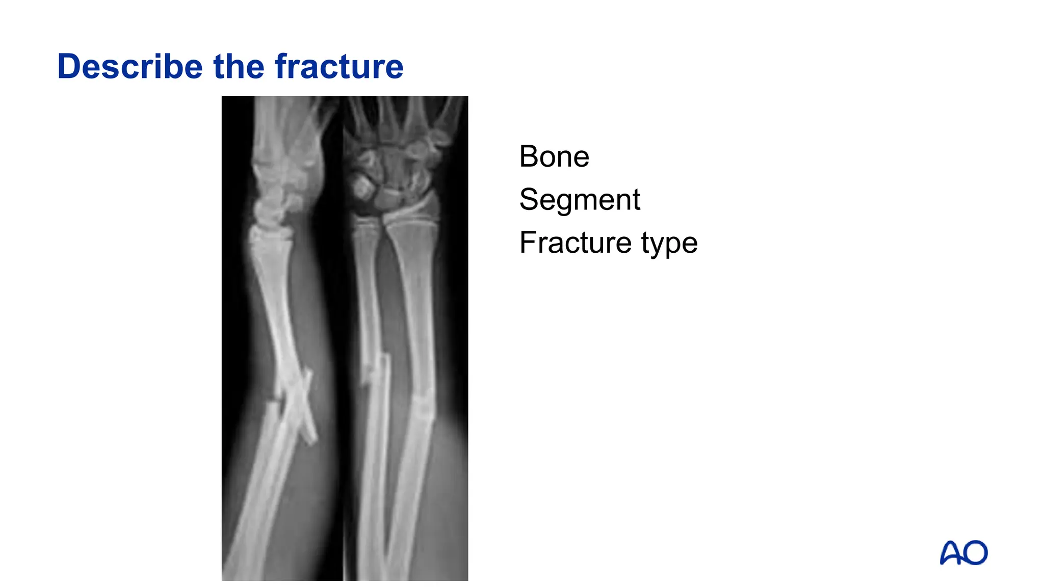 Fsp Orp Discussion English Forearm Fracture Nlogo Ppt