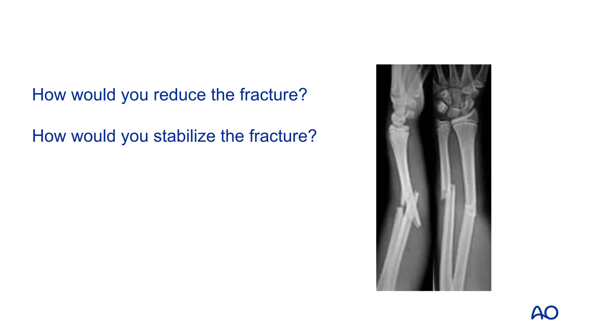 Fsp Orp Discussion English Forearm Fracture Nlogo Ppt