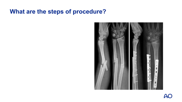 FSP_ORP_Discussion_English_Forearm_fracture_nLogo.ppt