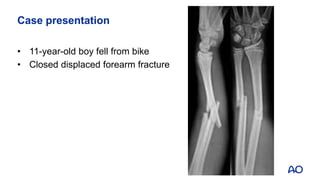 FSP_ORP_Discussion_English_Forearm_fracture_nLogo.ppt