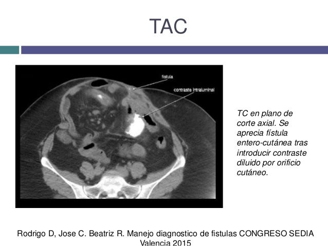 Fístulas abdominales