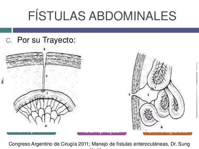 Fístulas abdominales